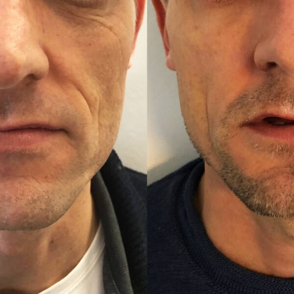 Lipofilling - van Dijk Clinic