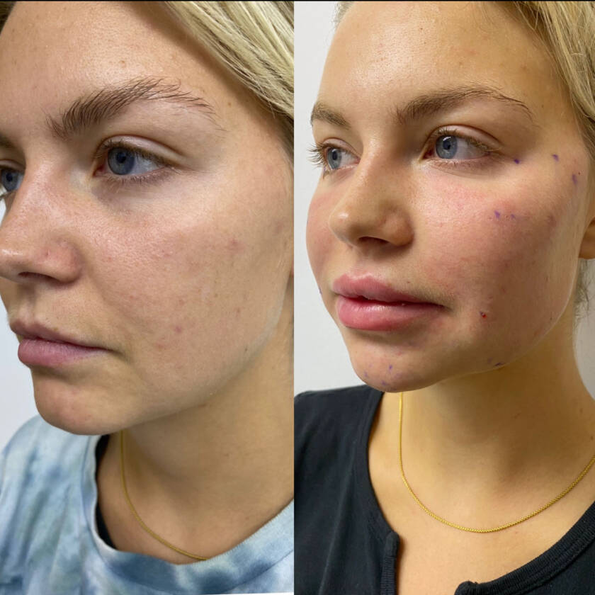 Lipofilling - van Dijk Clinic